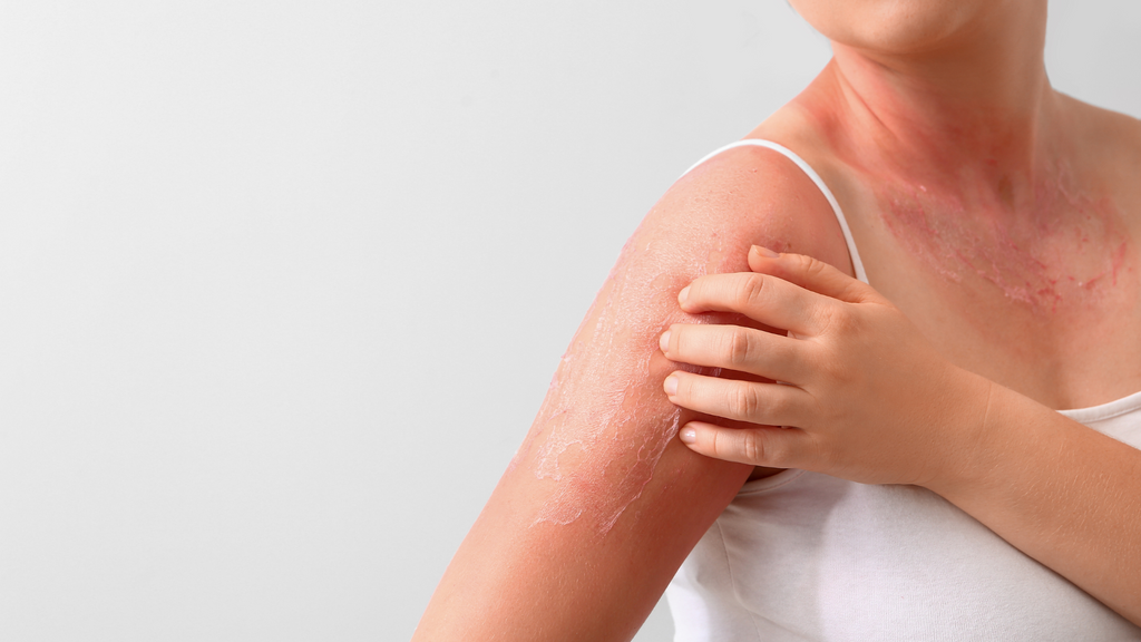 Why does skin peel after sunburn? – Solbari Australia